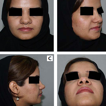Middle East nose in Rhinoplasty - Rhinoplasty Archive