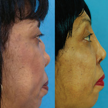 Repair of Septal Perforations in Revision Septoplasty