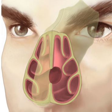 Septal Perforation - Rhinoplasty Archive