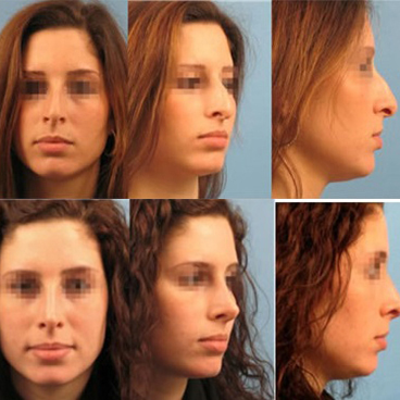 Management of the middle vault - Rhinoplasty Archive