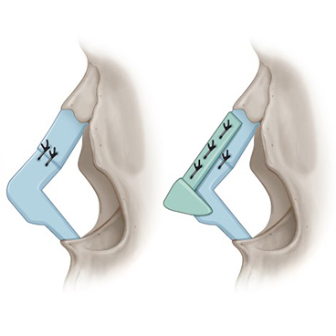 How to Manage Deviated Nose: Personal Tips - Rhinoplasty Archive