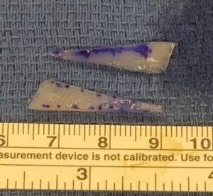 Lateral Crural Tensioning and Articulated Alar Rim Grafts - Rhinoplasty ...