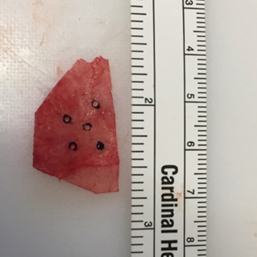 Maximizing the septal graft: use of osteo-cartilaginous septal graft in ...