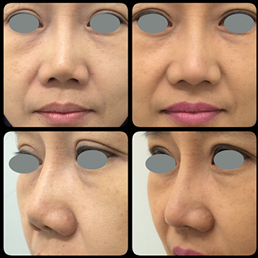 Acellular Dermal Matrix (ADM) in Asian tip and dorsal augmentation ...