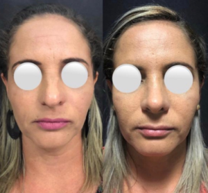 Nasal Tip Sutures - Rhinoplasty Archive