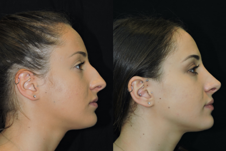 Tip onlay graft: the Peck graft revisited - Rhinoplasty Archive