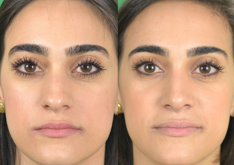 Tip onlay graft: the Peck graft revisited - Rhinoplasty Archive