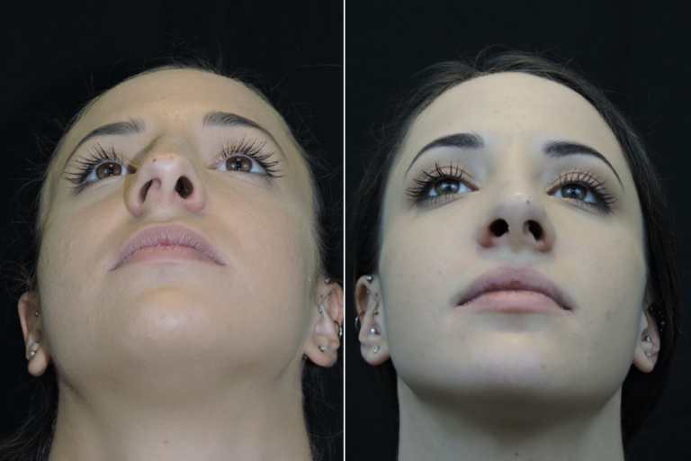 Tip onlay graft: the Peck graft revisited - Rhinoplasty Archive