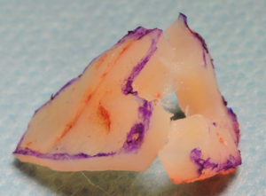 Tip onlay graft: the Peck graft revisited - Rhinoplasty Archive