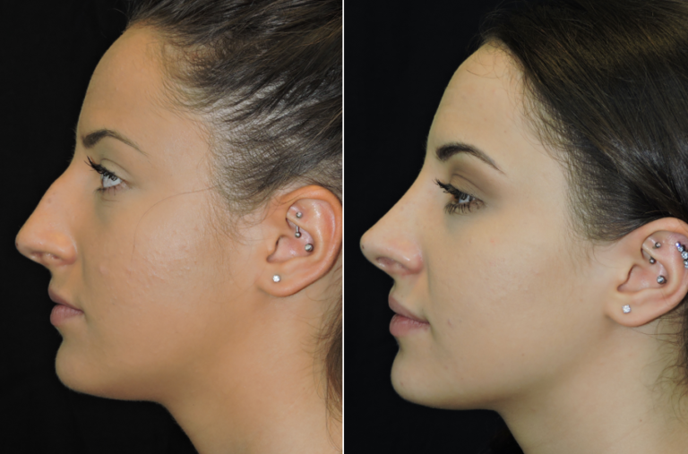 Tip onlay graft: the Peck graft revisited - Rhinoplasty Archive