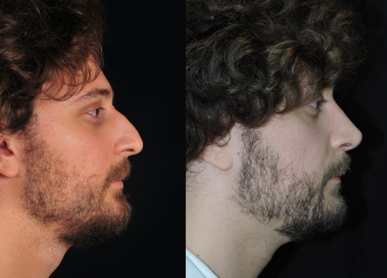 Tip onlay graft: the Peck graft revisited - Rhinoplasty Archive