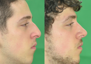 Tip onlay graft: the Peck graft revisited - Rhinoplasty Archive