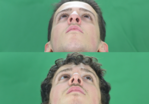 Tip onlay graft: the Peck graft revisited - Rhinoplasty Archive