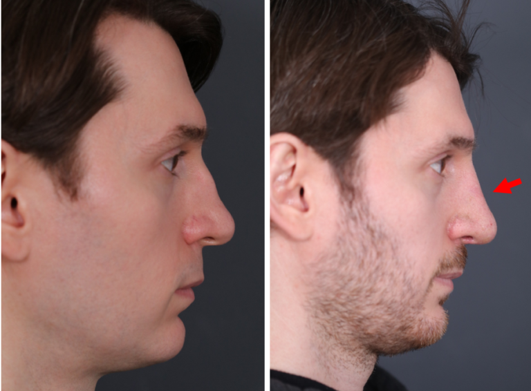 Use of The Diced Cartilage Glue Graft in Rhinoplasty - Rhinoplasty Archive