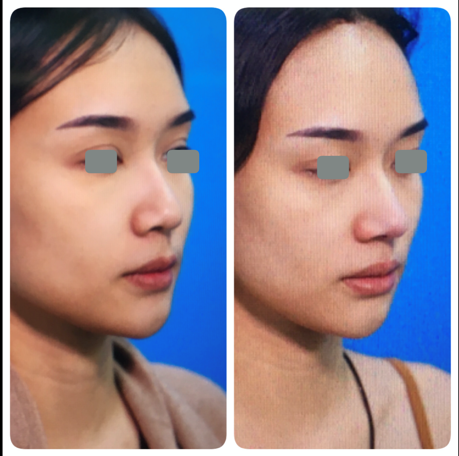 Acellular Dermal Matrix (ADM) in Asian tip and dorsal augmentation ...