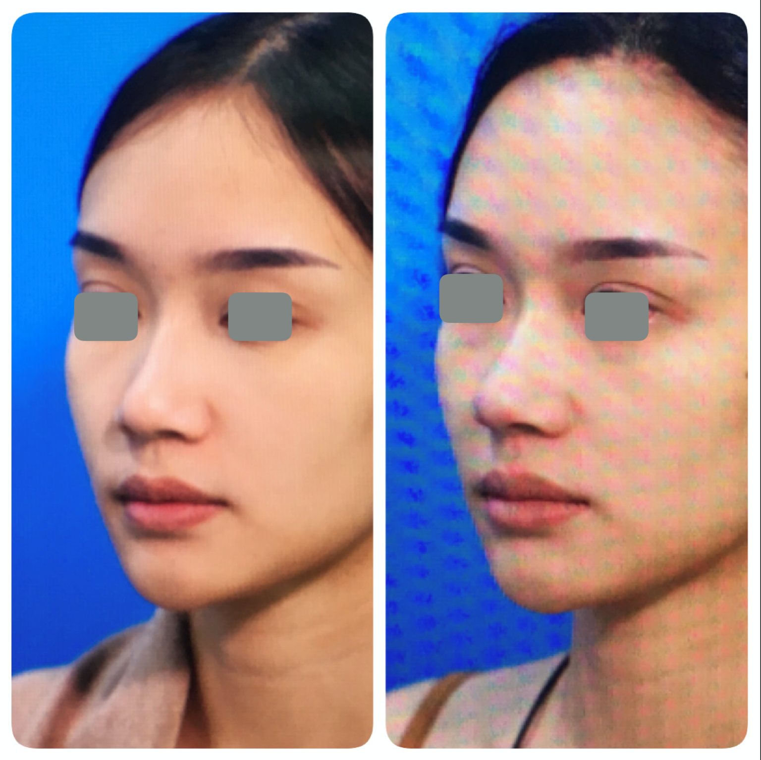 Acellular Dermal Matrix (ADM) in Asian tip and dorsal augmentation ...