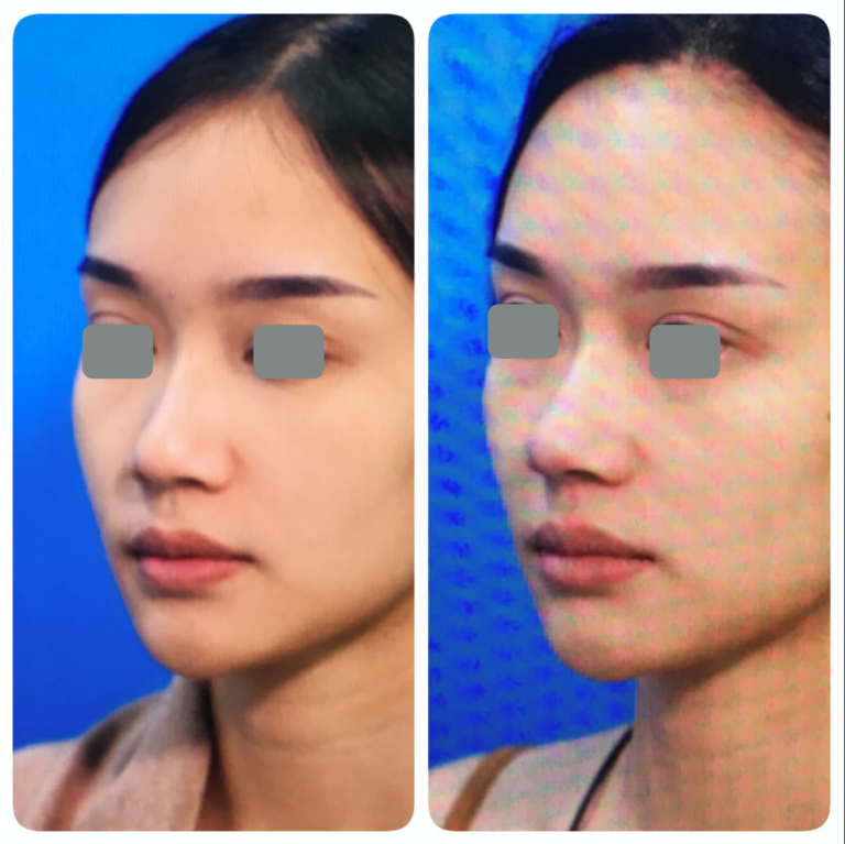 Acellular Dermal Matrix (ADM) in Asian tip and dorsal augmentation ...