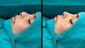 Acellular Dermal Matrix (ADM) in Asian tip and dorsal augmentation ...