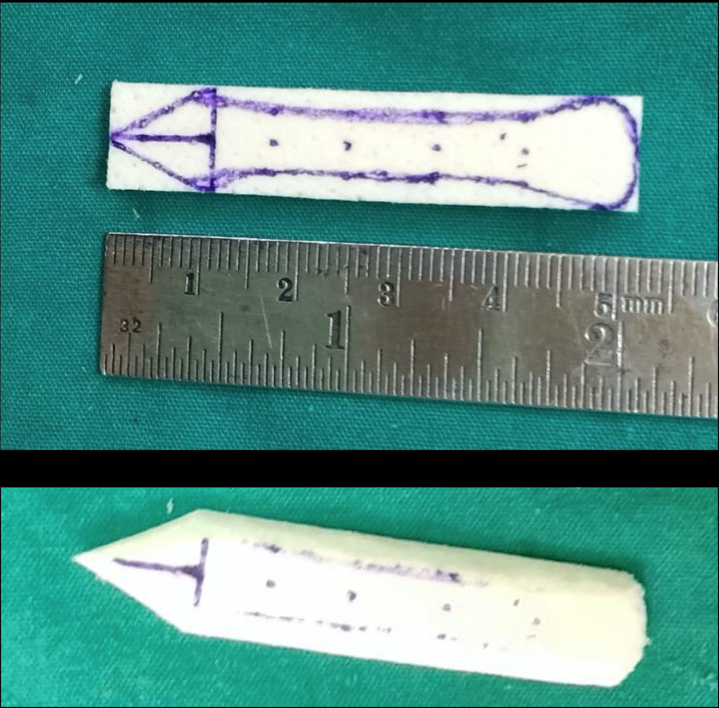 Acellular Dermal Matrix (ADM) in Asian tip and dorsal augmentation ...