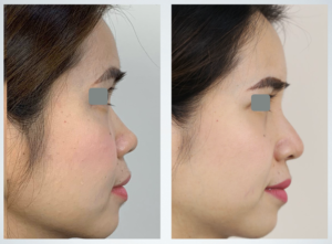 Acellular Dermal Matrix (ADM) in Asian tip and dorsal augmentation ...