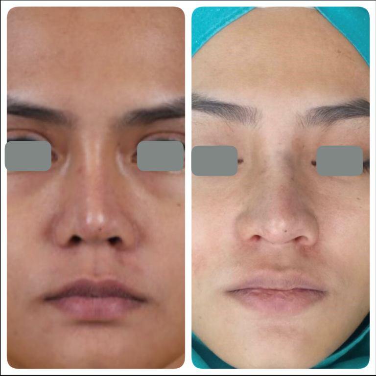 Acellular Dermal Matrix (ADM) in Asian tip and dorsal augmentation ...