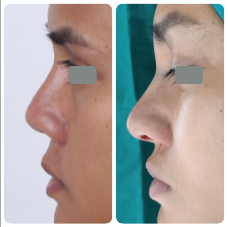 Acellular Dermal Matrix (ADM) in Asian tip and dorsal augmentation ...