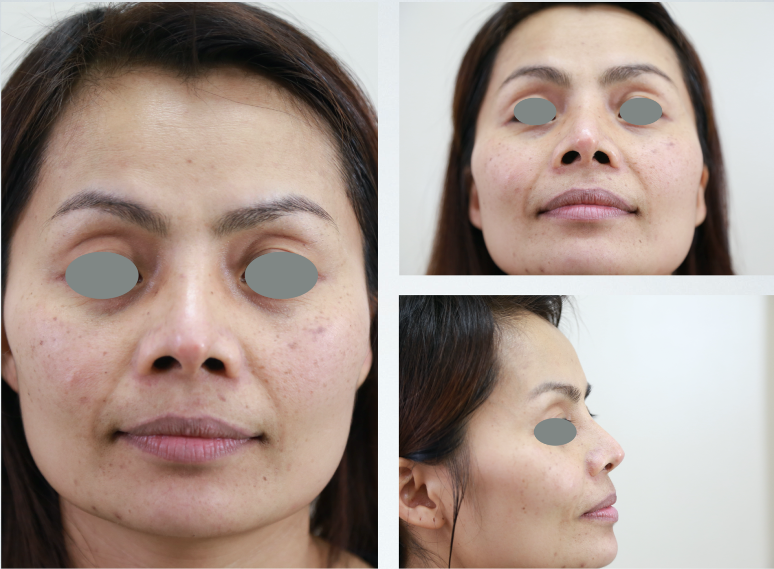 Acellular Dermal Matrix (ADM) in Asian tip and dorsal augmentation ...