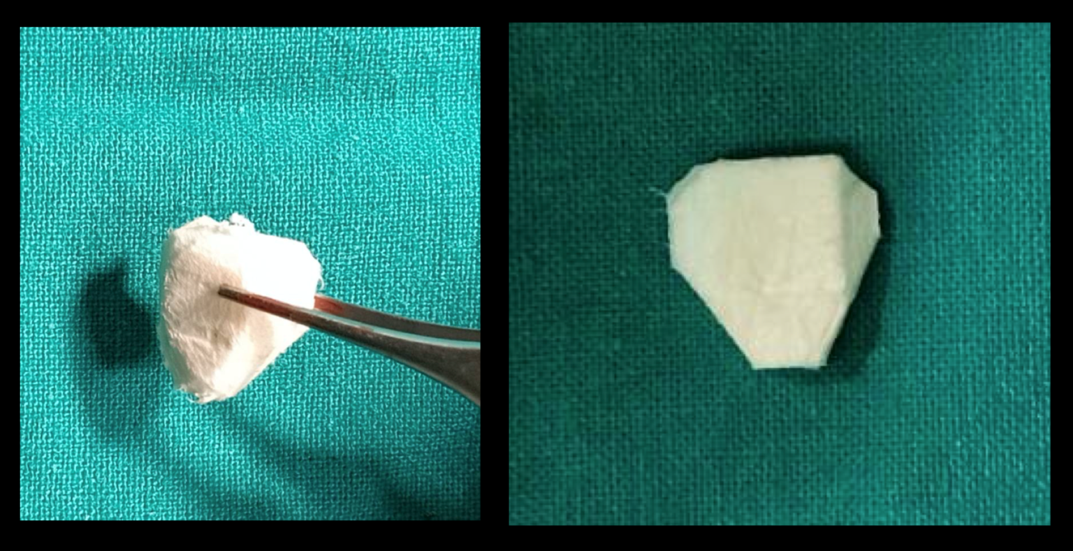Acellular Dermal Matrix (ADM) in Asian tip and dorsal augmentation ...