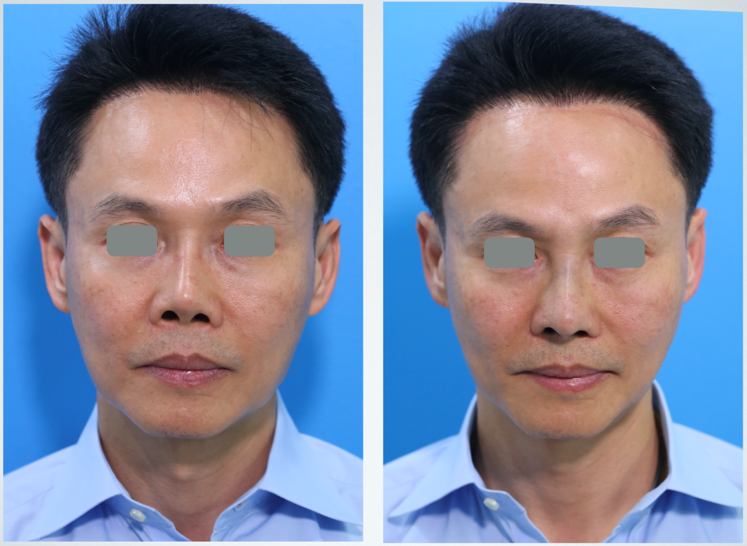 Acellular Dermal Matrix (ADM) in Asian tip and dorsal augmentation ...