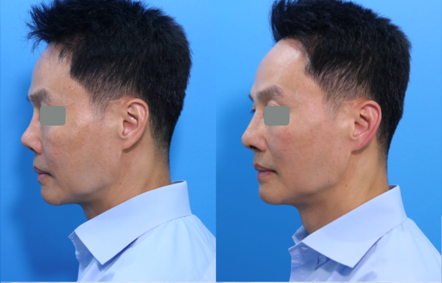 Acellular Dermal Matrix (ADM) in Asian tip and dorsal augmentation ...