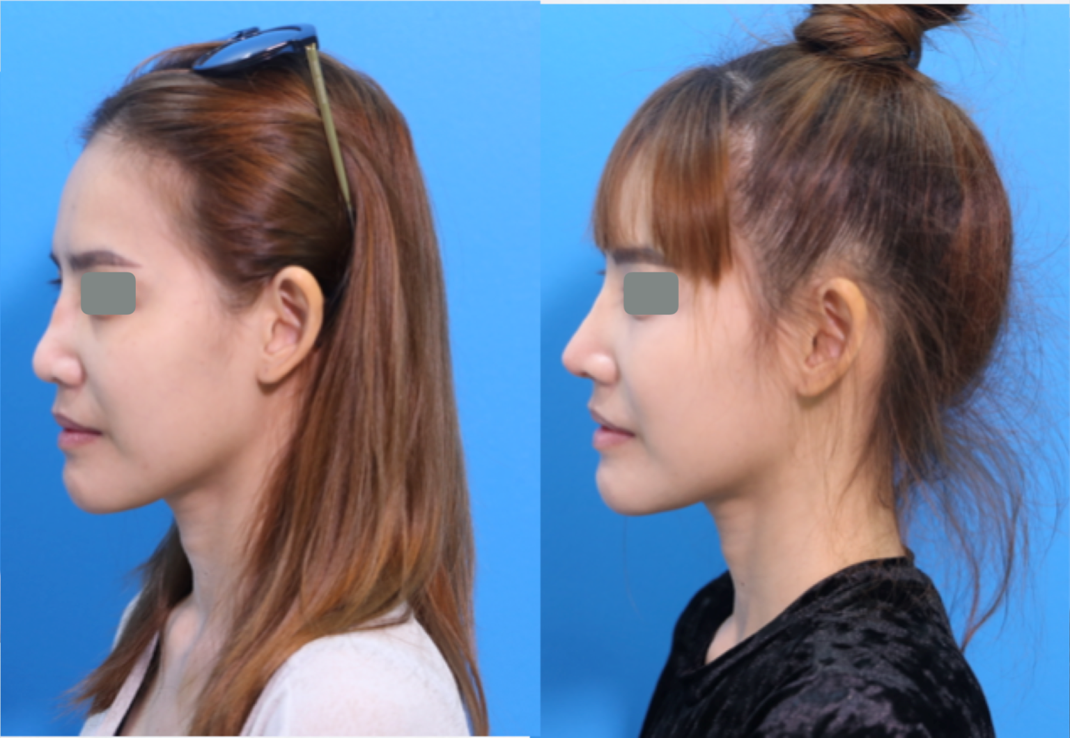 Acellular Dermal Matrix (ADM) in Asian tip and dorsal augmentation ...