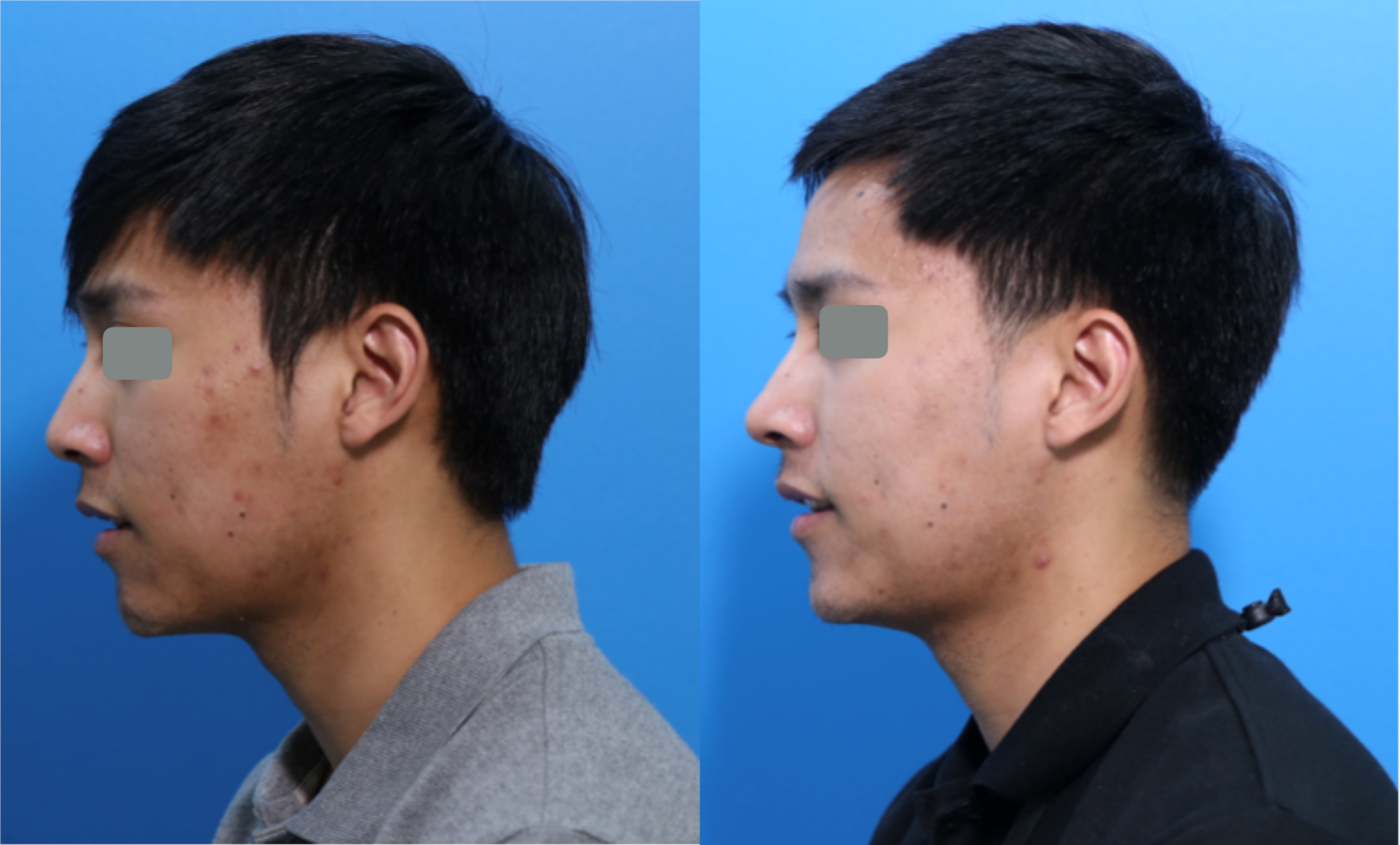 Acellular Dermal Matrix (ADM) in Asian tip and dorsal augmentation ...