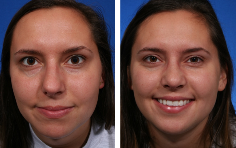 Integrated Alar-Lateral Crural Strut Graft: A Novel Technique for ...