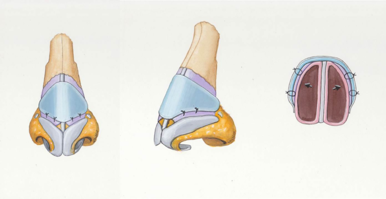 The Butterfly graft - Rhinoplasty Archive