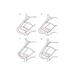 Supporting the Nasal Tip - Rhinoplasty Archive