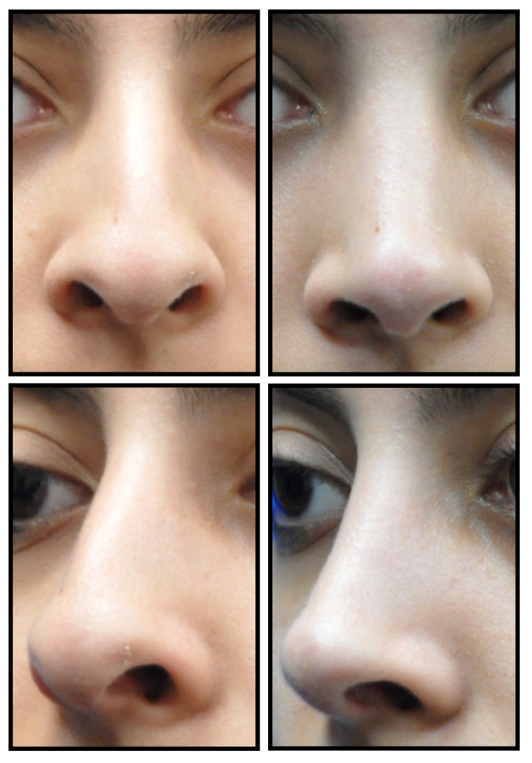 Cranial Tip Sutures for Tip Refinement - Rhinoplasty Archive
