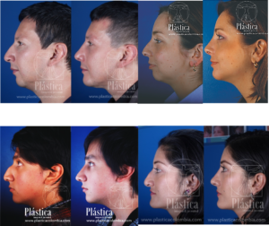 Overprojected Nasal Tip: Technique To Decrease The Nasal Tip Projection ...