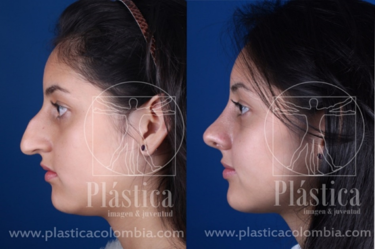 Overprojected Nasal Tip: Technique To Decrease The Nasal Tip Projection ...