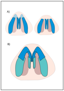 Overprojected Nasal Tip: Technique To Decrease The Nasal Tip Projection ...