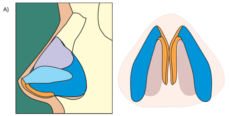 Overprojected Nasal Tip: Technique To Decrease The Nasal Tip Projection ...