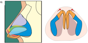 Overprojected Nasal Tip: Technique To Decrease The Nasal Tip Projection ...