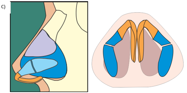 Overprojected Nasal Tip: Technique To Decrease The Nasal Tip Projection ...
