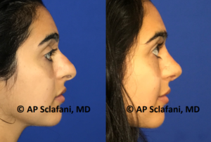 Mechanisms of Nasal Tip Deprojection: An Overview - Rhinoplasty Archive