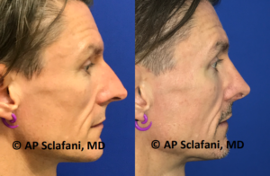 Mechanisms of Nasal Tip Deprojection: An Overview - Rhinoplasty Archive