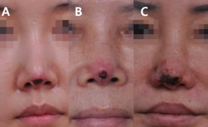 Symptoms and treatment of necrosis of the nose after filler injection ...