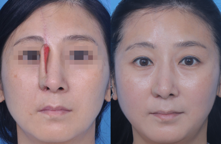 Symptoms and treatment of necrosis of the nose after filler injection ...