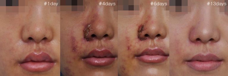 Symptoms and treatment of necrosis of the nose after filler injection ...