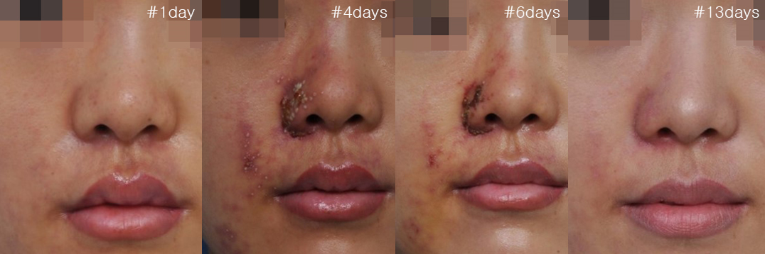 Symptoms and treatment of necrosis of the nose after filler injection ...