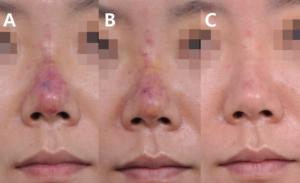 Symptoms and treatment of necrosis of the nose after filler injection ...