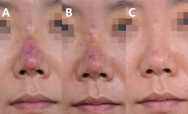 Symptoms and treatment of necrosis of the nose after filler injection ...